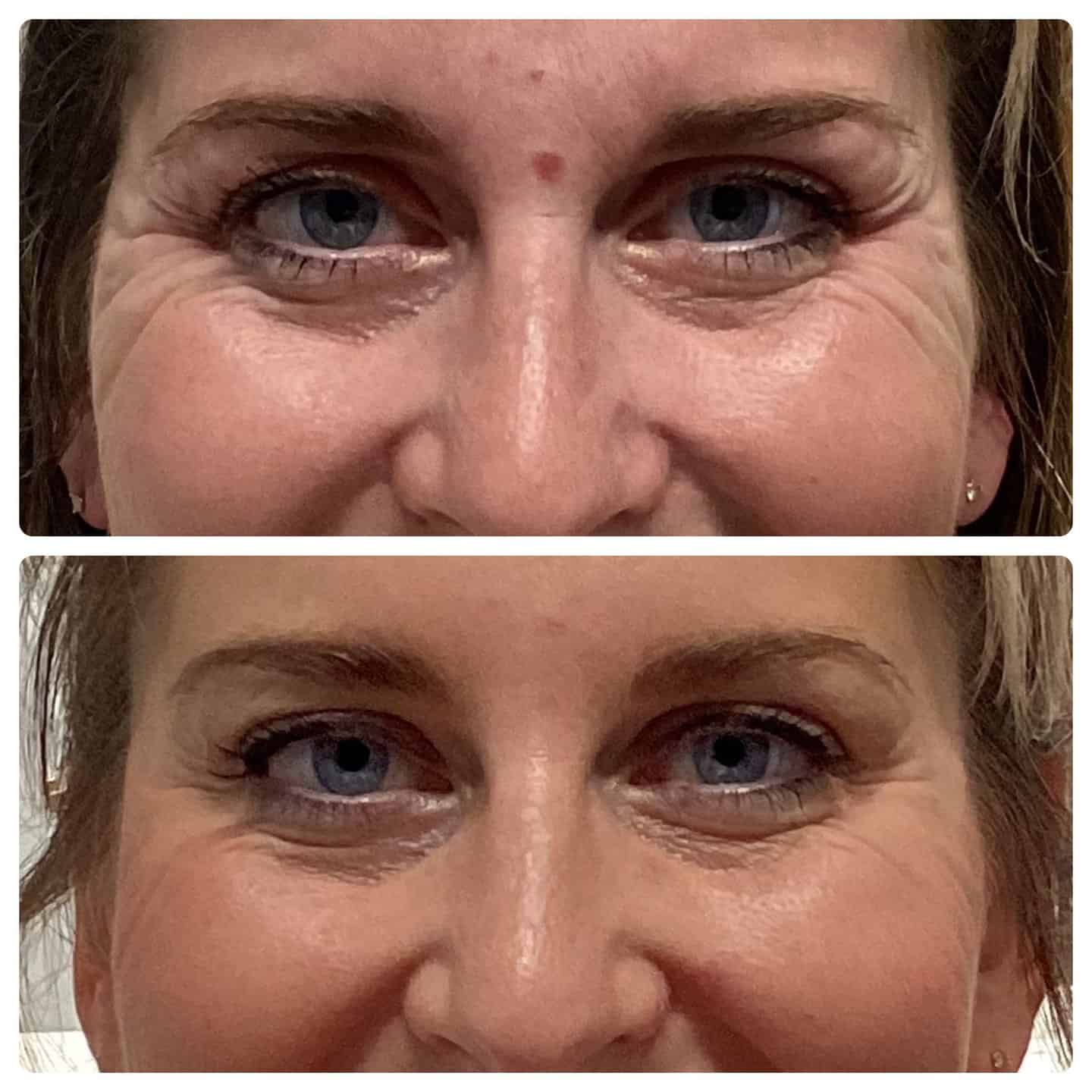 Jeuveau - Revive at The Group Med Spa