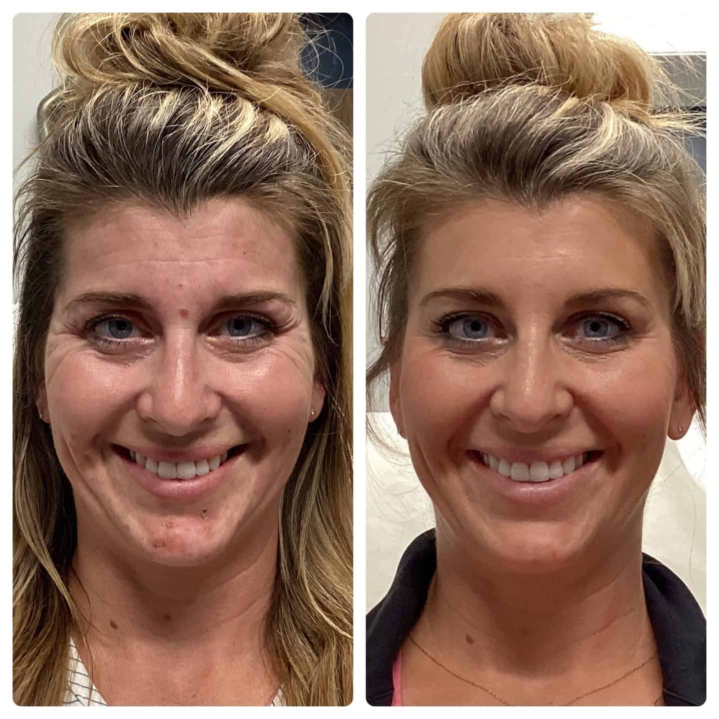 Jeuveau - Revive at The Group Med Spa